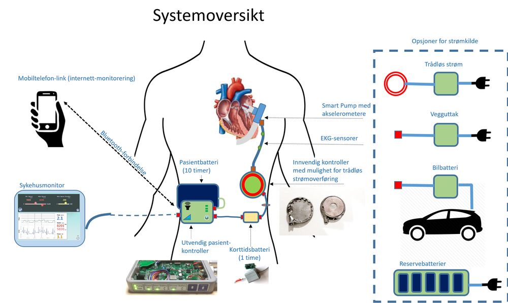 En norskutviklet hjertepumpe kan årlig redde livet til titusener av ...
